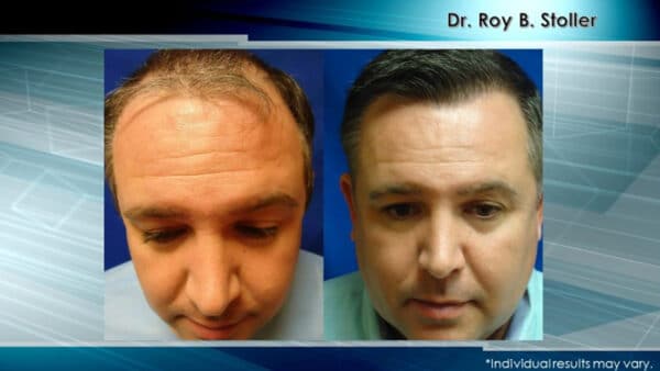 Hair Transplant Leading Expert | Dr. Stoller